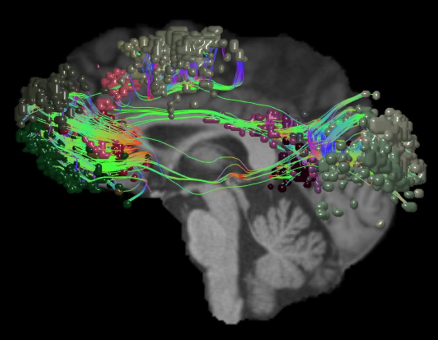 The Default Mode Network Dmn